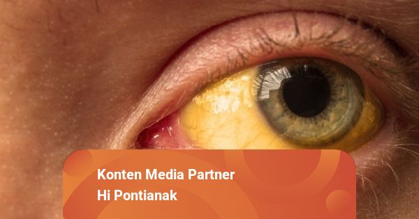 Heboh Kasus Hepatitis Akut Misterius pada Anak, Dinkes Kalbar Siapkan ... Heboh Kasus Hepatitis Akut Misterius pada Anak, Dinkes Kalbar Siapkan ...